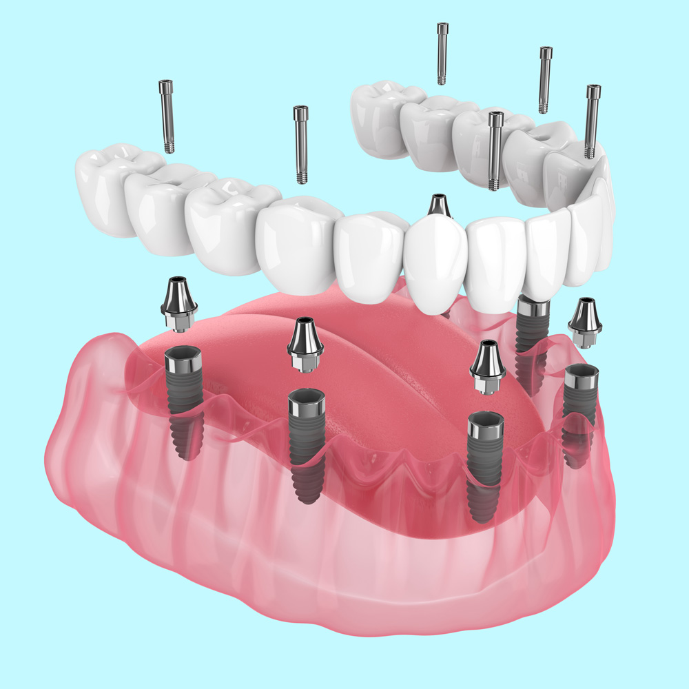 Full Mouth Dental Implants - Galveston Dental